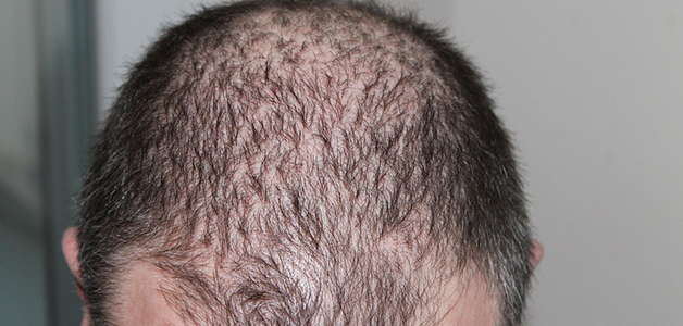 Haarausfall | Friseur.com