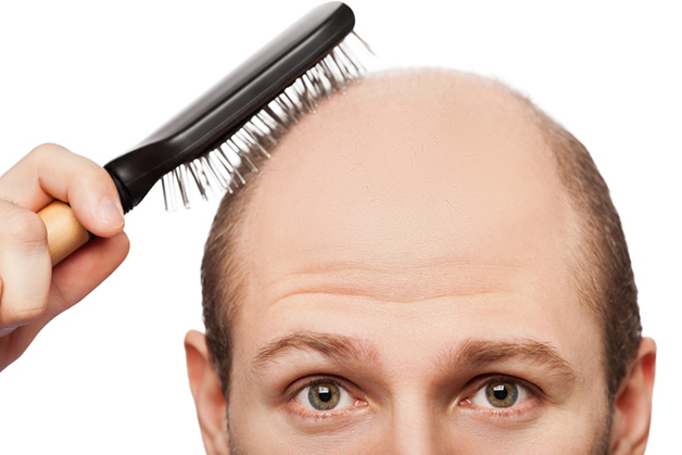Erblich bedingter Haarausfall – was tun? | Friseur.com